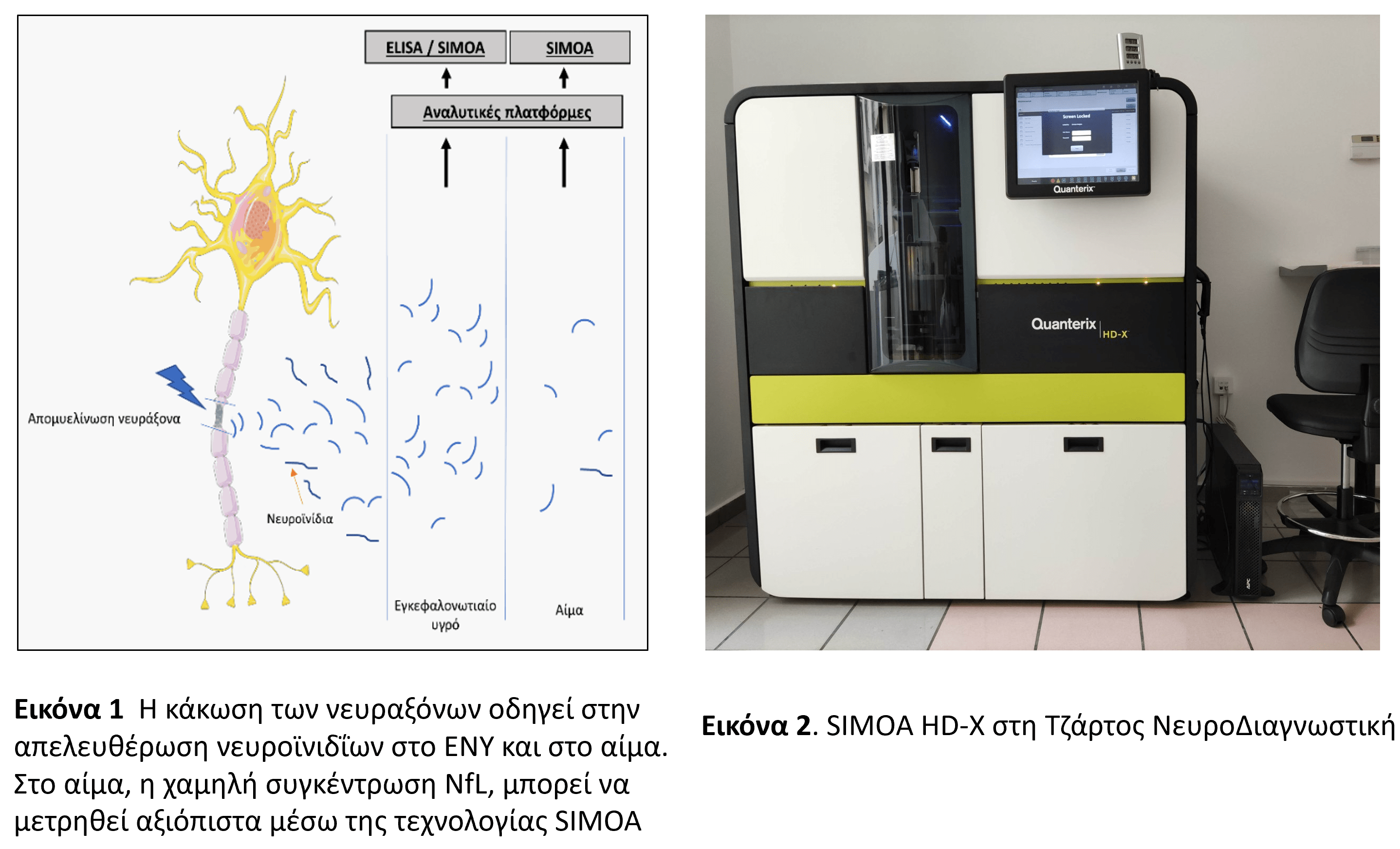 “Consensus Statement” για την μέτρηση των NfL στο αίμα, στην έρευνα και ...